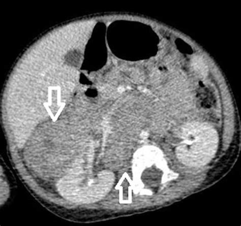 From Metastasis To Diagnosis Eurorad