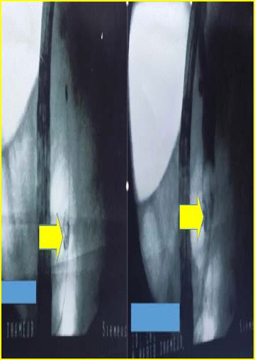 Ercp Before Left Picture And After Right Picture Contrast Agent Download Scientific