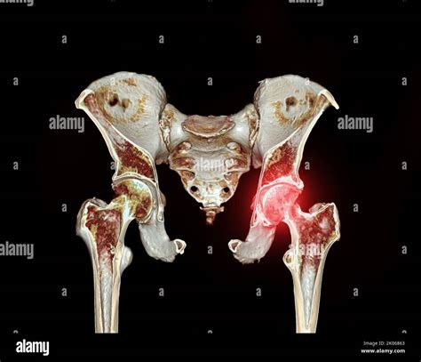 Ct Scan Of Pelvic Bone And Hip Joint 3d Rendering For Diagnosis Fracture Of Pelvic Bone And Hip