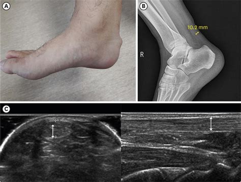 Tendon Xanthoma