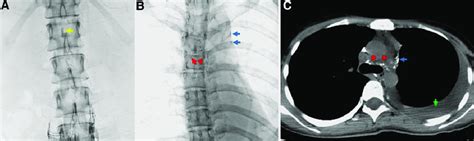 Lipiodol Based Lymphangiography And Ct Showing The Lymphatic Plexus Download Scientific Diagram