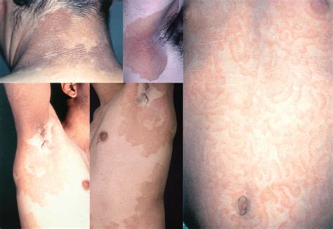 Erythrokeratodermia Variabilis