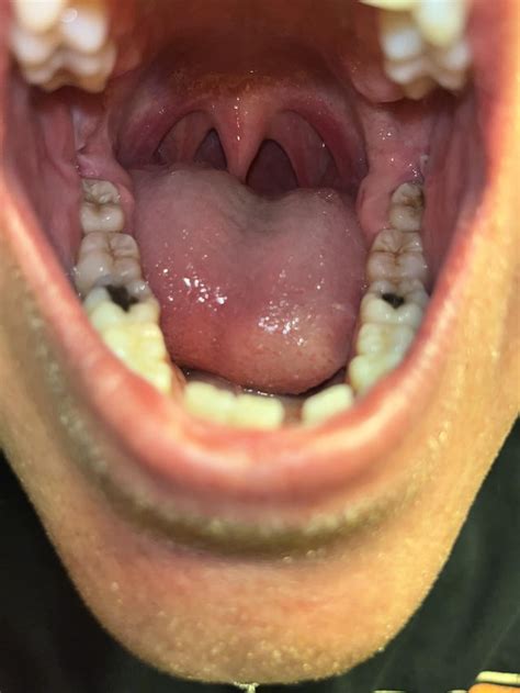 Does This Look Like Strep R Medical Advice