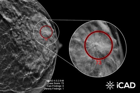 Profound Detection Version 40 The Next Generation In Early Breast