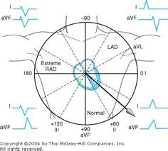 Image Result For Axis Deviation Ekg Interpretation Cheat Sheets Ekg