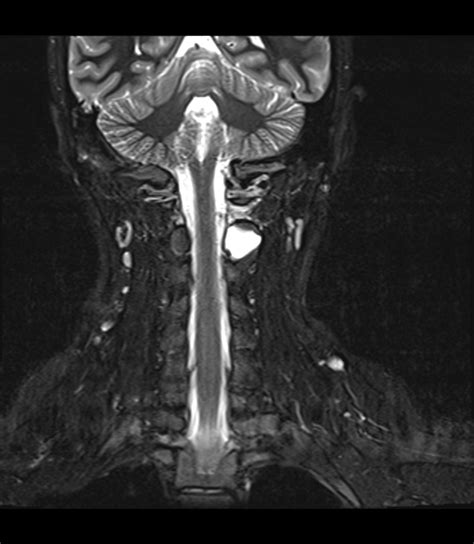 Aneurysmal Bone Cyst Spine