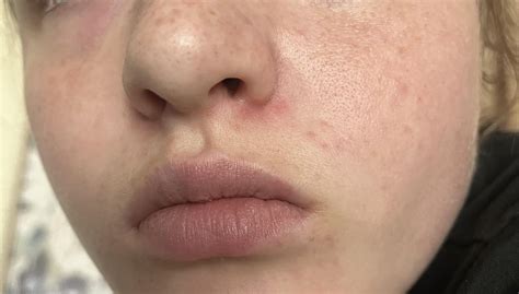 Redness Around Nose Racne