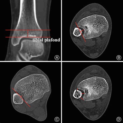 Measurement Of Fibular Notch Fn Related Morphological Parameters A Download Scientific
