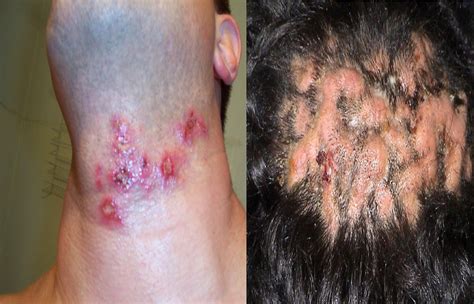Scalp Rash Pustules At Isabella Clubbe Blog