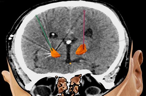 Pallidal Deep Brain Stimulation Improves Hpca‐linked Dyt 2 Dystonia Samanci 2024