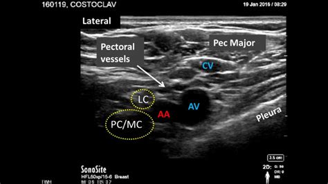 Infraclavicular Block