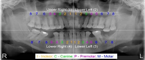 Figure 1 From Detection Of Proximal Caries At The Molar Teeth Using