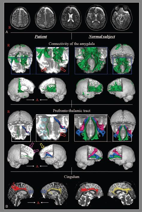 Severe Disinhibition Due To Injuries Of Neural Tracts Relate Medicine
