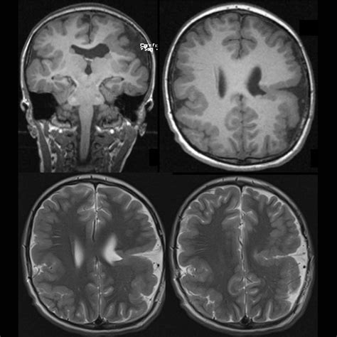 Polymicrogyria Pediatric Radiology Reference Article Pediatric