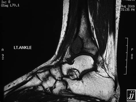 Msk Distal Tibial Cyst 1 Radioogle
