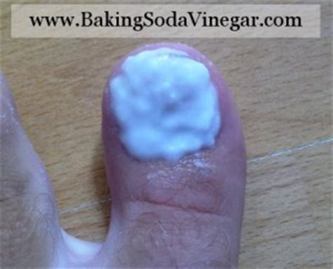 Toenail Fungus Treatment Baking Soda And Vinegar Uses