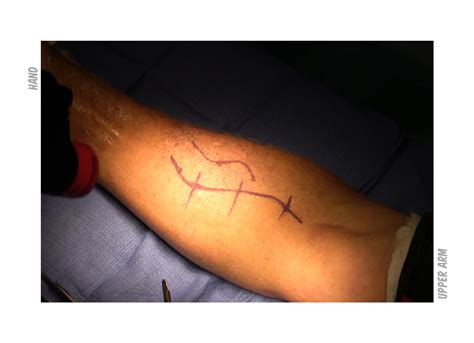 Median Nerve Forearm Decompression Surgical Education Learn Surgery Washington University