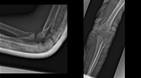 Anterior Elbow Dislocation Without Associated Fracture In An Adolescent