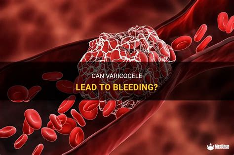 Can Varicocele Lead To Bleeding Medshun