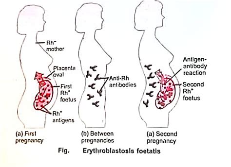 Solved Explainerythroblastosis Fetalis Course Hero