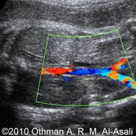 Fetal Genitourinary Abnormalities Flashcards Quizlet