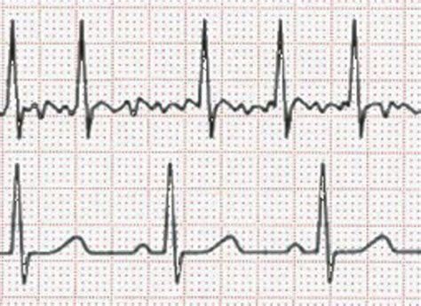 How To Read Ekgs Identifying Atrial Fibrillation Hubpages