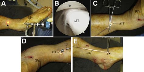 Posterior Tibial Tendon Tear
