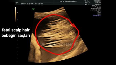 How Is Fetal Scalp Hair On The Back Of The Head Seen Floating On Ultrasound 37th Weeks Almost 9