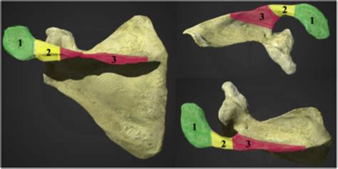 Scapular Spine Fracture Presentation Of Two Cases And Novel Surgical