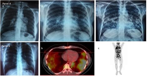 A The Scaddings Vision Of Sarcoidosis Through The Chest