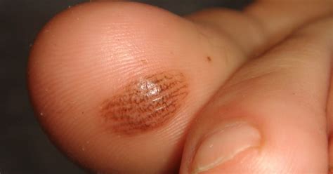 Dermoscopy Lattice Like Pattern