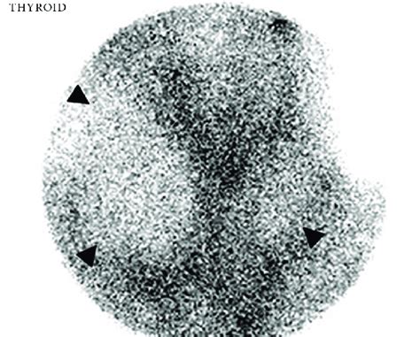 Technetium 99m Pertechnetate Thyroid Scan Shows Large Photon Defects Of Download Scientific