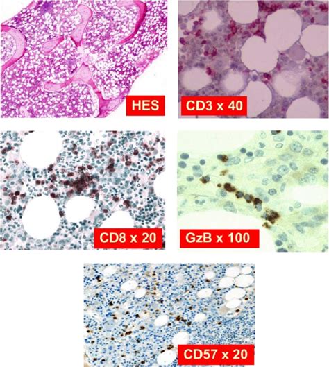 Chronic Neutropenia In Lgl Leukemia And Rheumatoid Arthritis Pmc