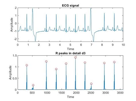 R Peaks Localization In An ECG Signal Of Human Suffering Of Arrhythmia