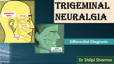Differential Diagnosis Trigeminal Neuralgia At Donna Casas Blog