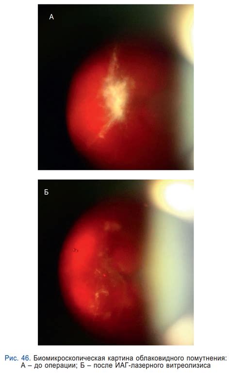 Рис 46 Биомикроскопическая картина облаковидного помутнения А до операции Б после ИАГ