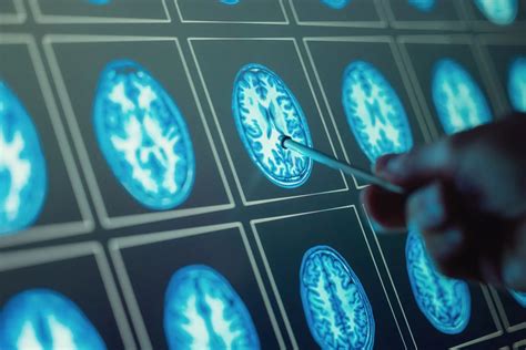 The Quick Guide To Apob And Why It May Matter More Than Ldl Levels Levels