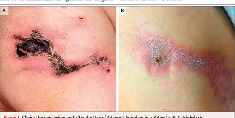Figure 1 From Calciphylaxis Semantic Scholar