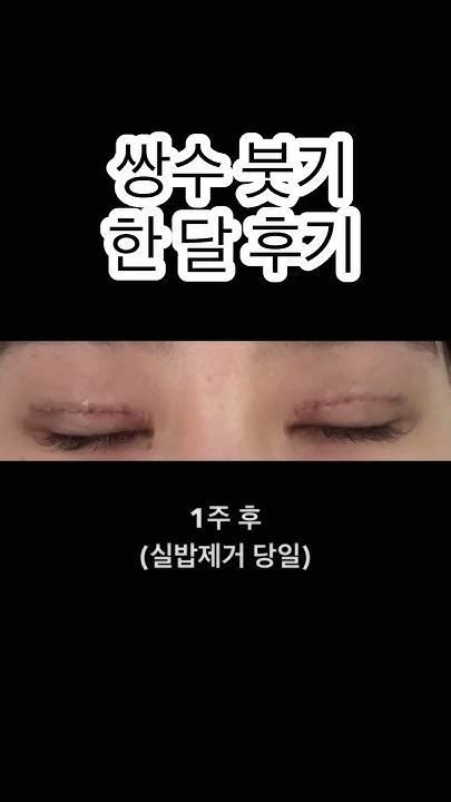 절개 쌍수 한달차 붓기 빠지는 과정 절개눈매교정 리얼후기 Shorts 쌍수 후기 Youtube