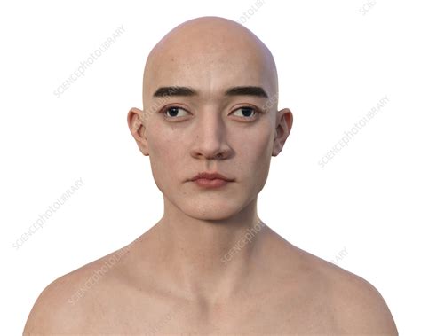 Man With Exotropia Illustration Stock Image F042 4888 Science Photo Library