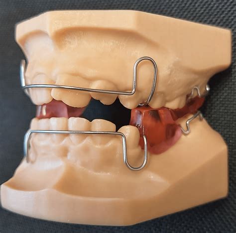 Twin Block Laboratoire Dentaire Orthodesign Sarl