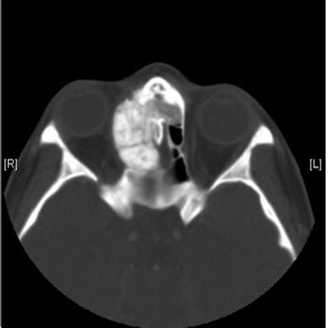 Paranasal Coronal Ct Scan Shows Right Ethmoid Sinus And Nasal Cavity