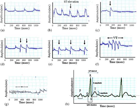 Examples Of Electrocardiogram Recordings And Definition Of Various
