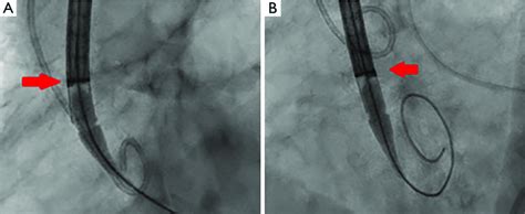 Hat Marker Orientation Of The Medtronic Corevalve Evolut Delivery Download Scientific Diagram