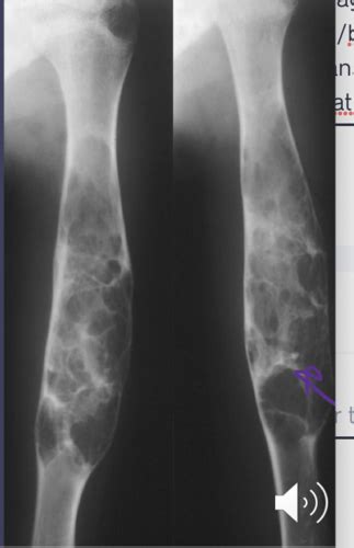 Tumors And Radiological Reports Flashcards Quizlet