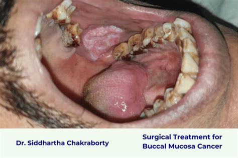 Buccal Mucosa Cancer Early Detection And Treatment Options