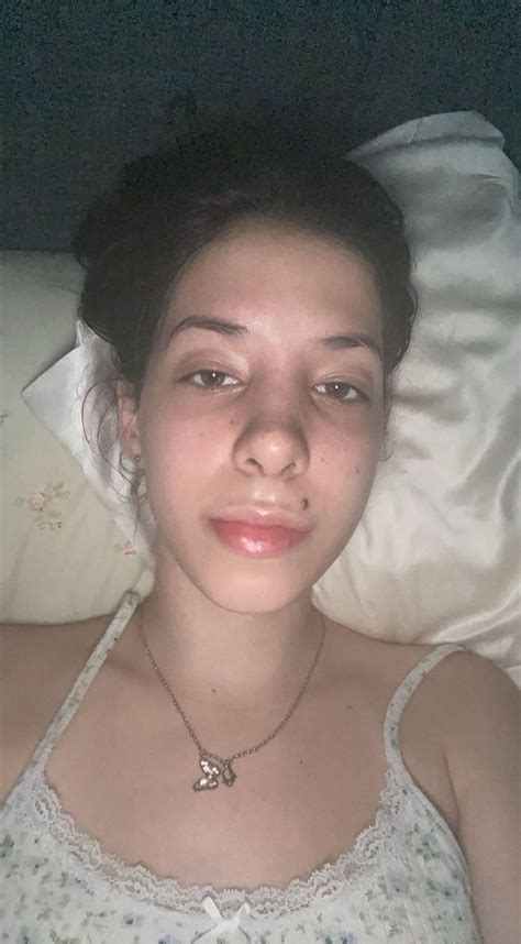 Nose Before And After 2 5 Years Later R Plasticsurgery