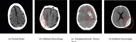 Figure 1 From Automatic Detection And Classiﬁcation Of Brain Hemorrhages Semantic Scholar