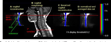 Figure 1 From Microstructure Of The Midbrain And Cervical Spinal Cord In Idiopathic Restless