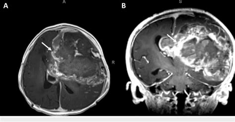 Post Resection Imaging Mris Status Post The First Subtotal Resection Download Scientific